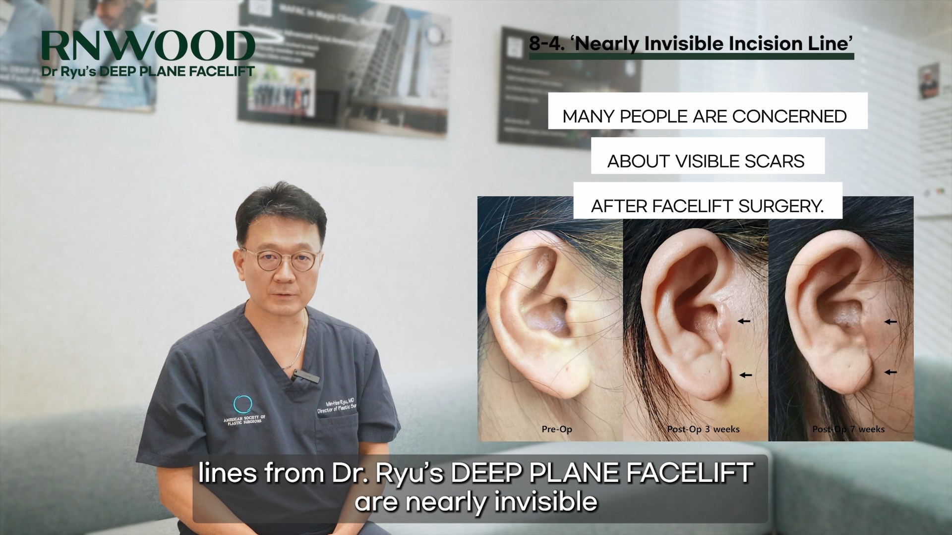 [8 Key Features of ‘Dr. Ryu's DEEP PLANE FACELIFT’] 8-4. ‘Nearly ...