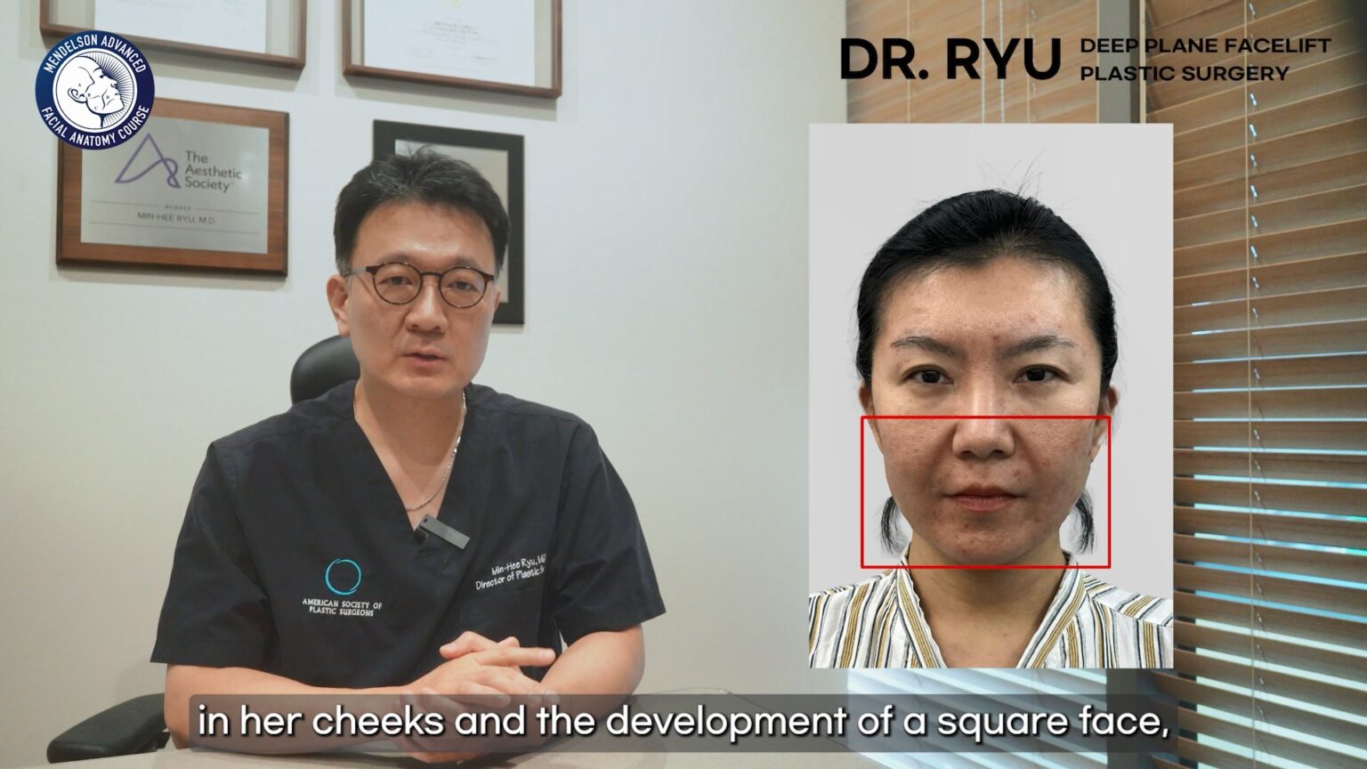 Review Case 1: Dr Ryu’s Deep Plane Facelift - Deep Plane Facelift Dr ...