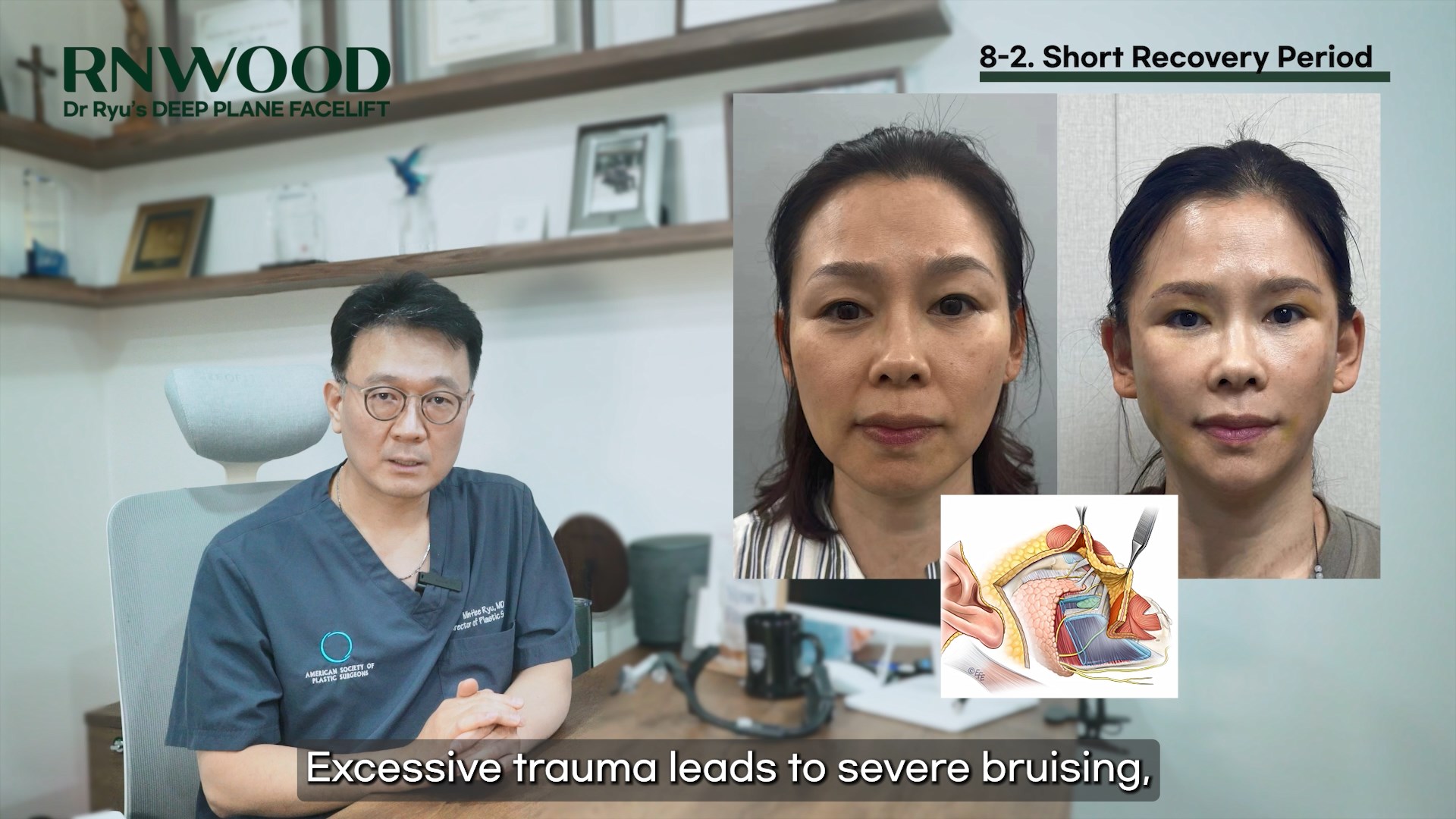 [8 Key Features of ‘Dr. Ryu's DEEP PLANE FACELIFT’] 8-2. Short Recovery ...