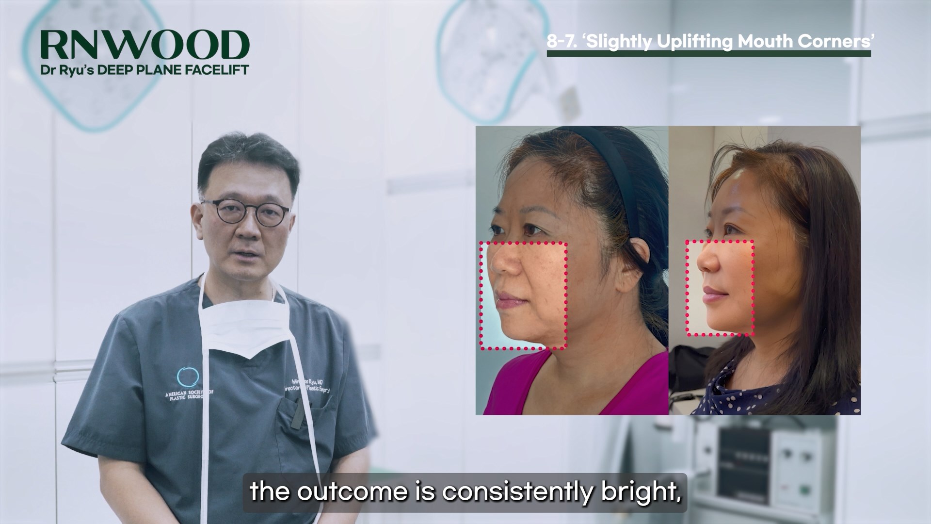 [8 Key Features of ‘Dr. Ryu's DEEP PLANE FACELIFT’] 8-7. ‘Slightly ...