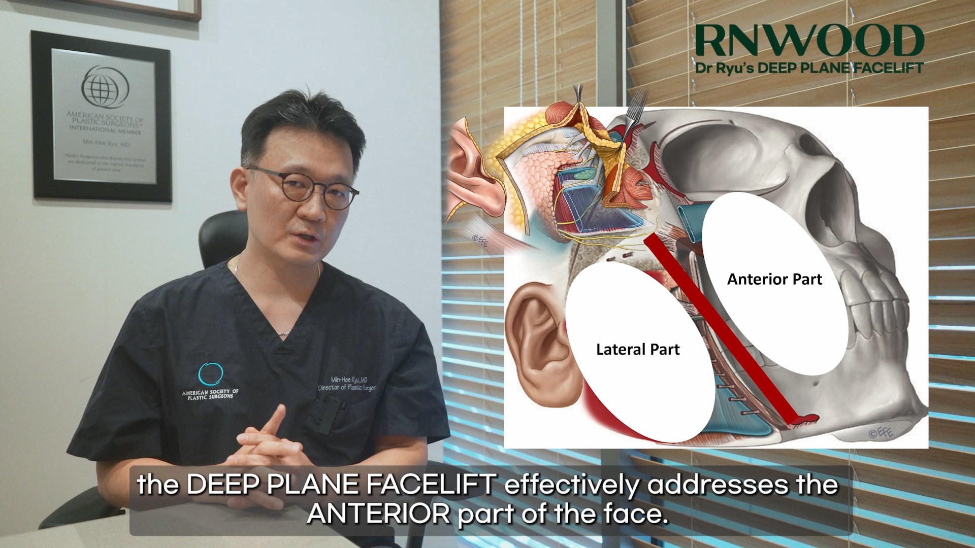 Patient Q&A 1: What is a DEEP PLANE FACELIFT? - Deep Plane Facelift Dr ...